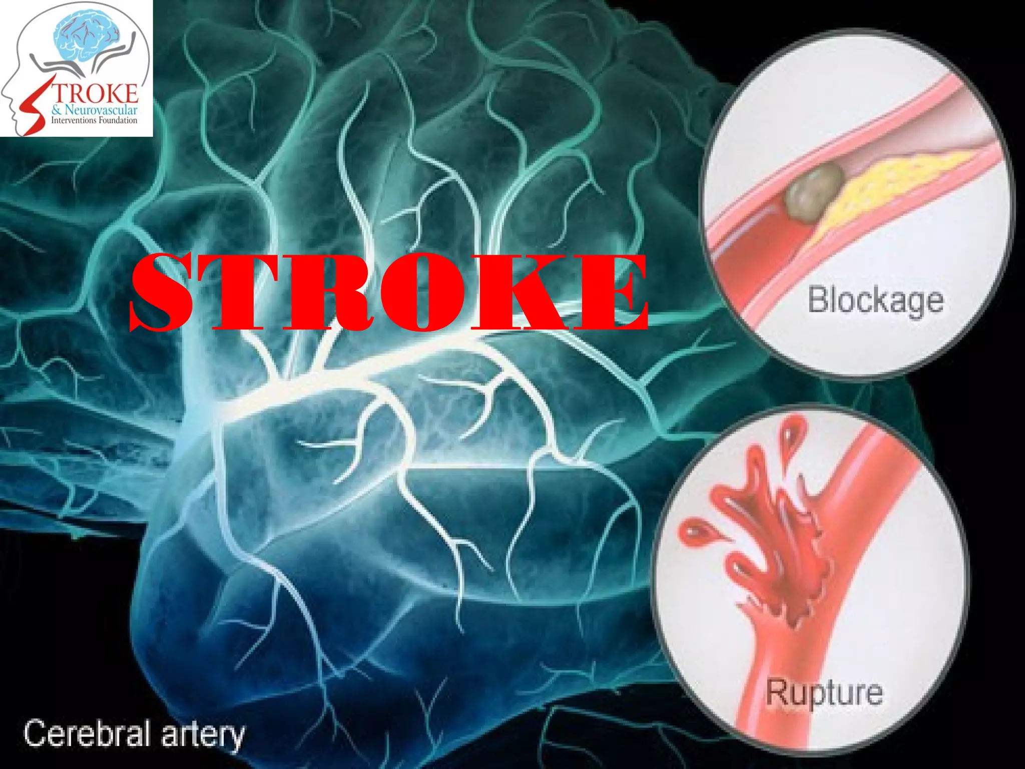 Stroke-Understanding the Basics | PPT