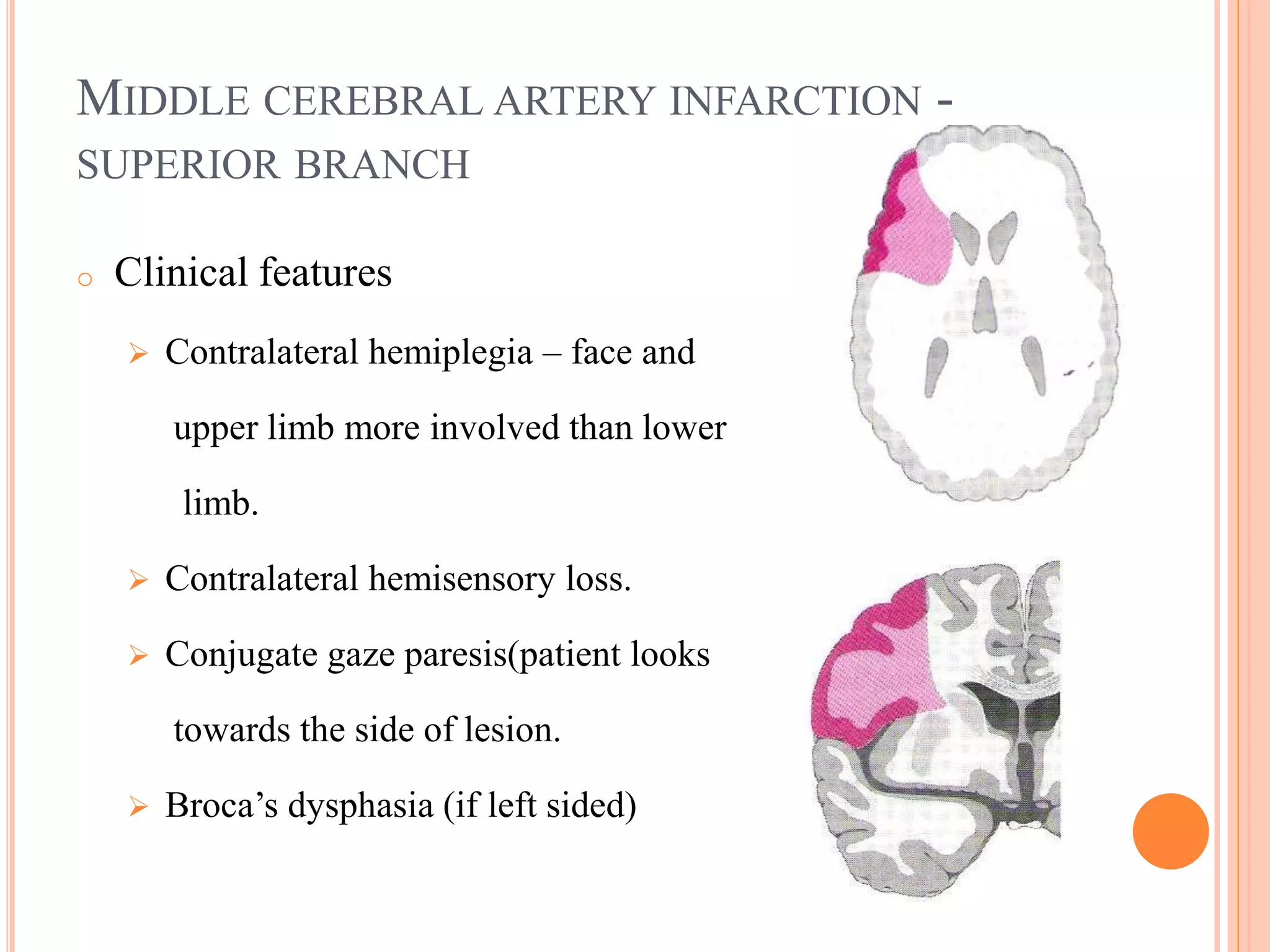 Stroke ppt | PPTX