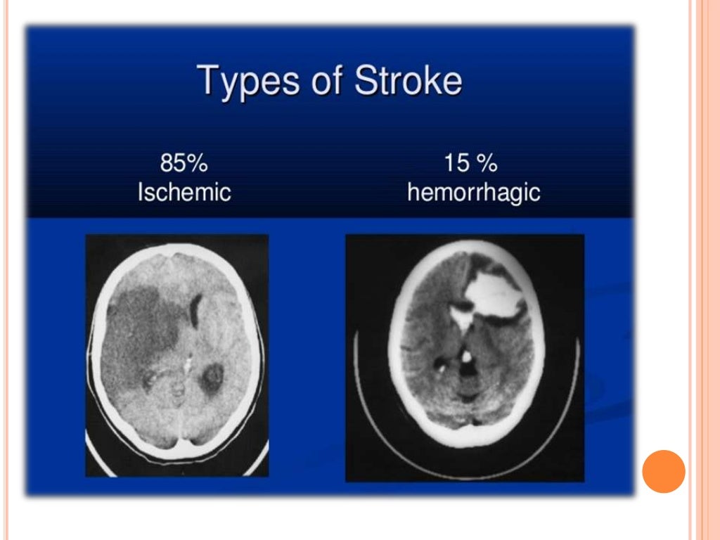 Stroke ppt
