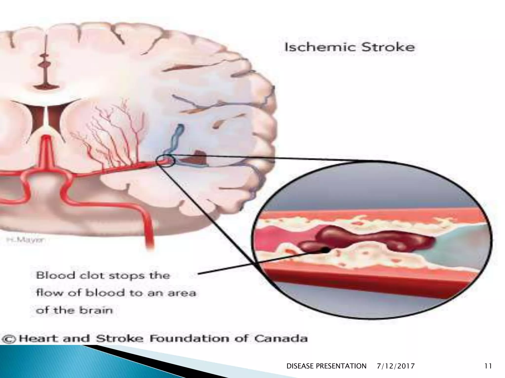 Stroke presentation | PPTX