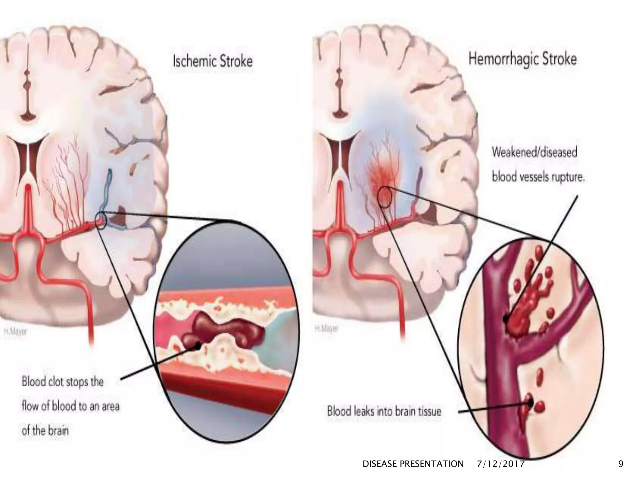 Stroke presentation | PPTX