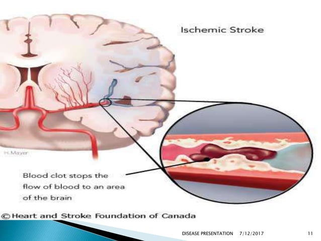 Stroke presentation | PPTX | Brain and Nervous System Disorders ...