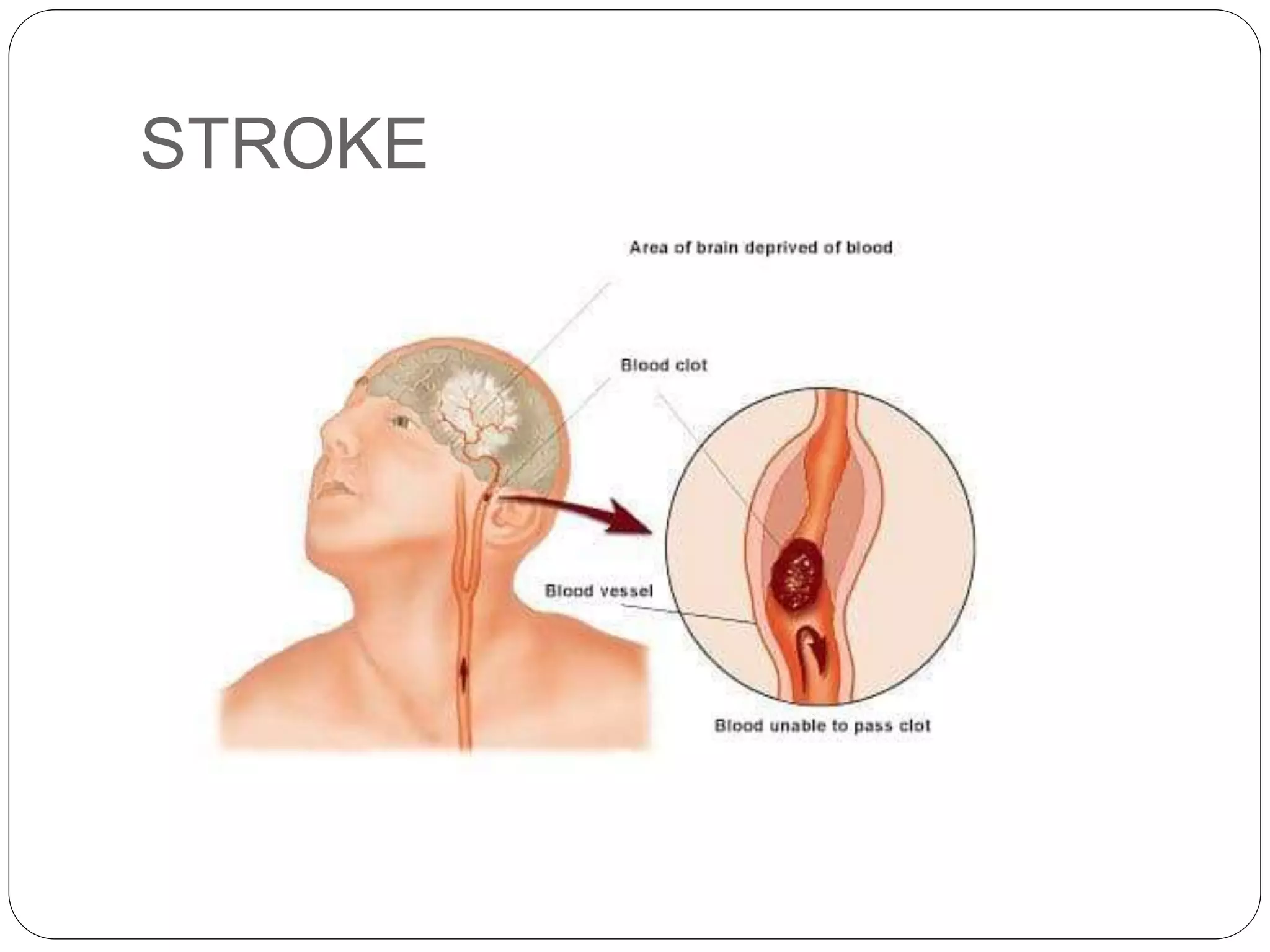 Stroke presentation By Saba Arif | PPT