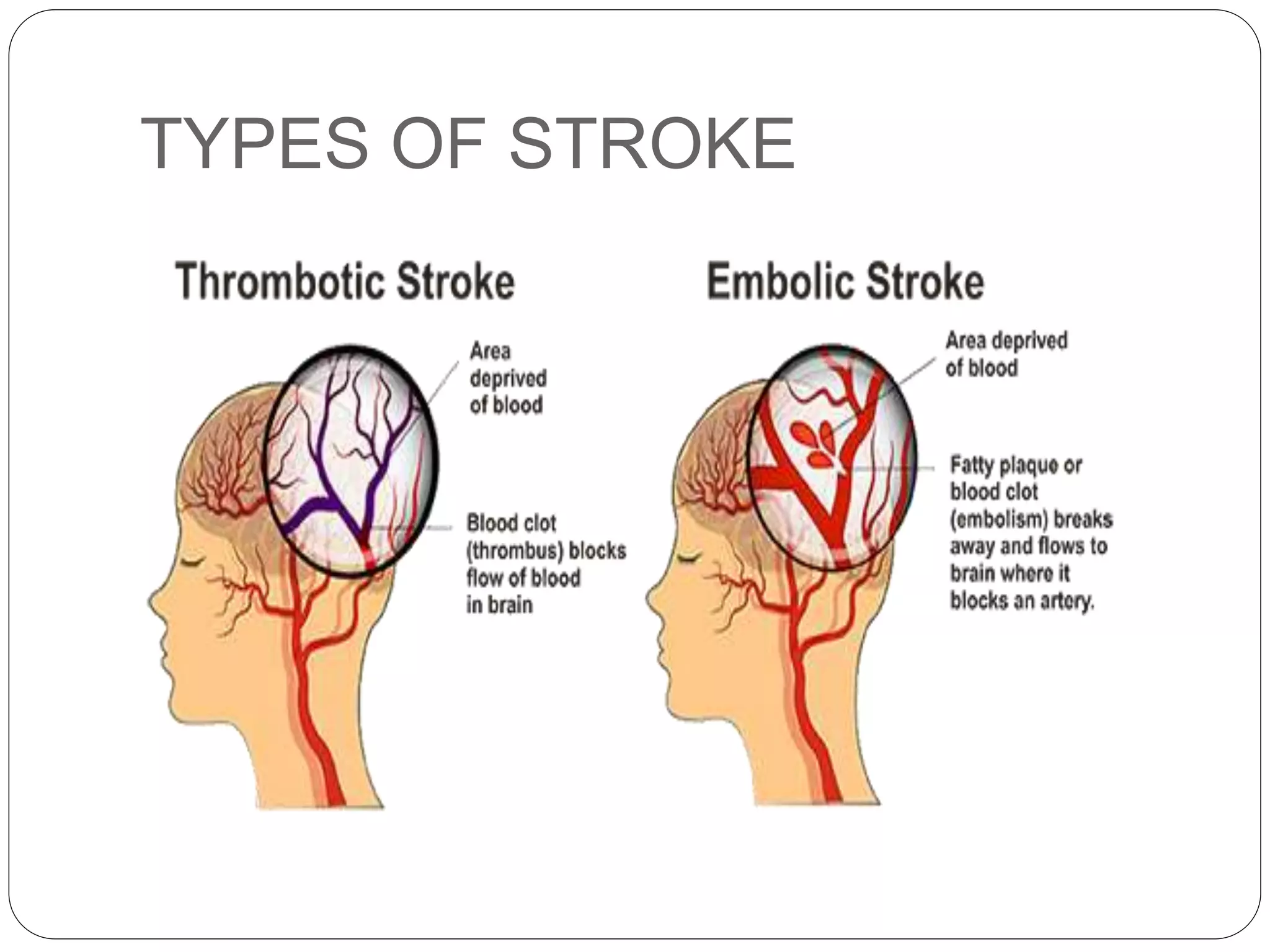 Stroke presentation By Saba Arif | PPT