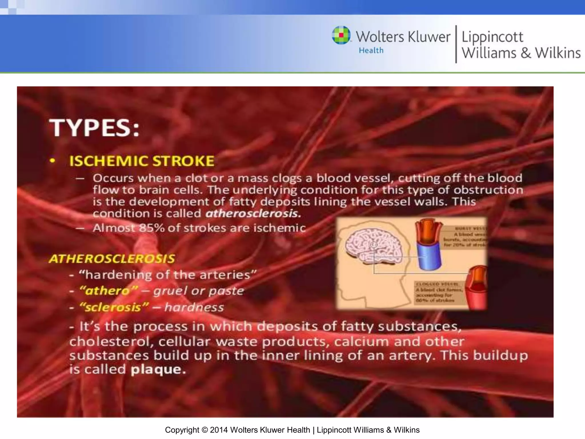 stroke presentation.ppt | Brain and Nervous System Disorders | Diseases and Conditions