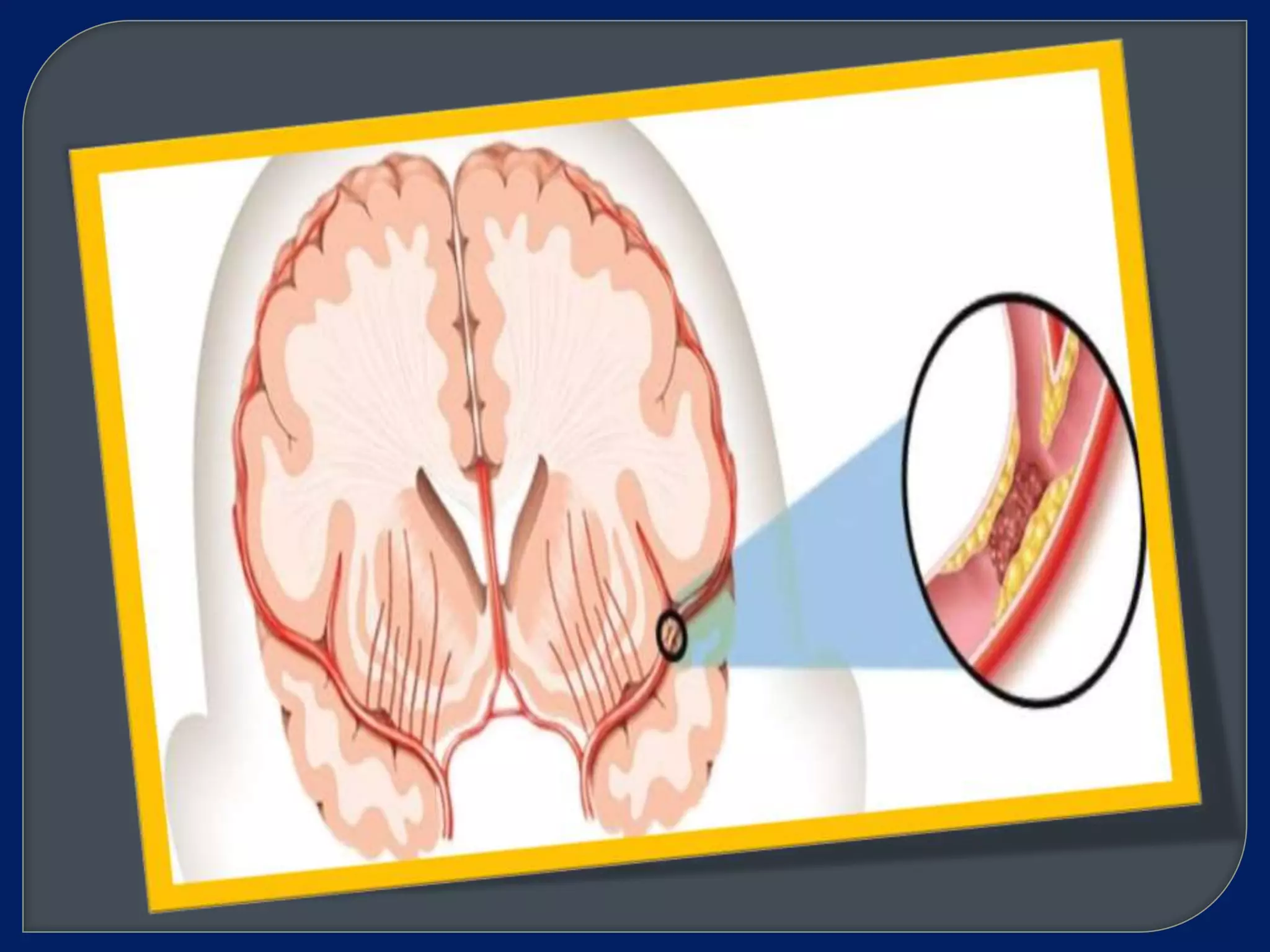 Stroke preventable and curable medicine jobelyn | PPTX