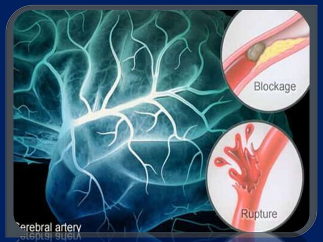 Stroke preventable and curable medicine jobelyn | PPTX