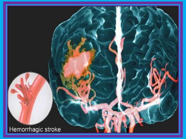 Stroke preventable and curable medicine jobelyn | PPTX