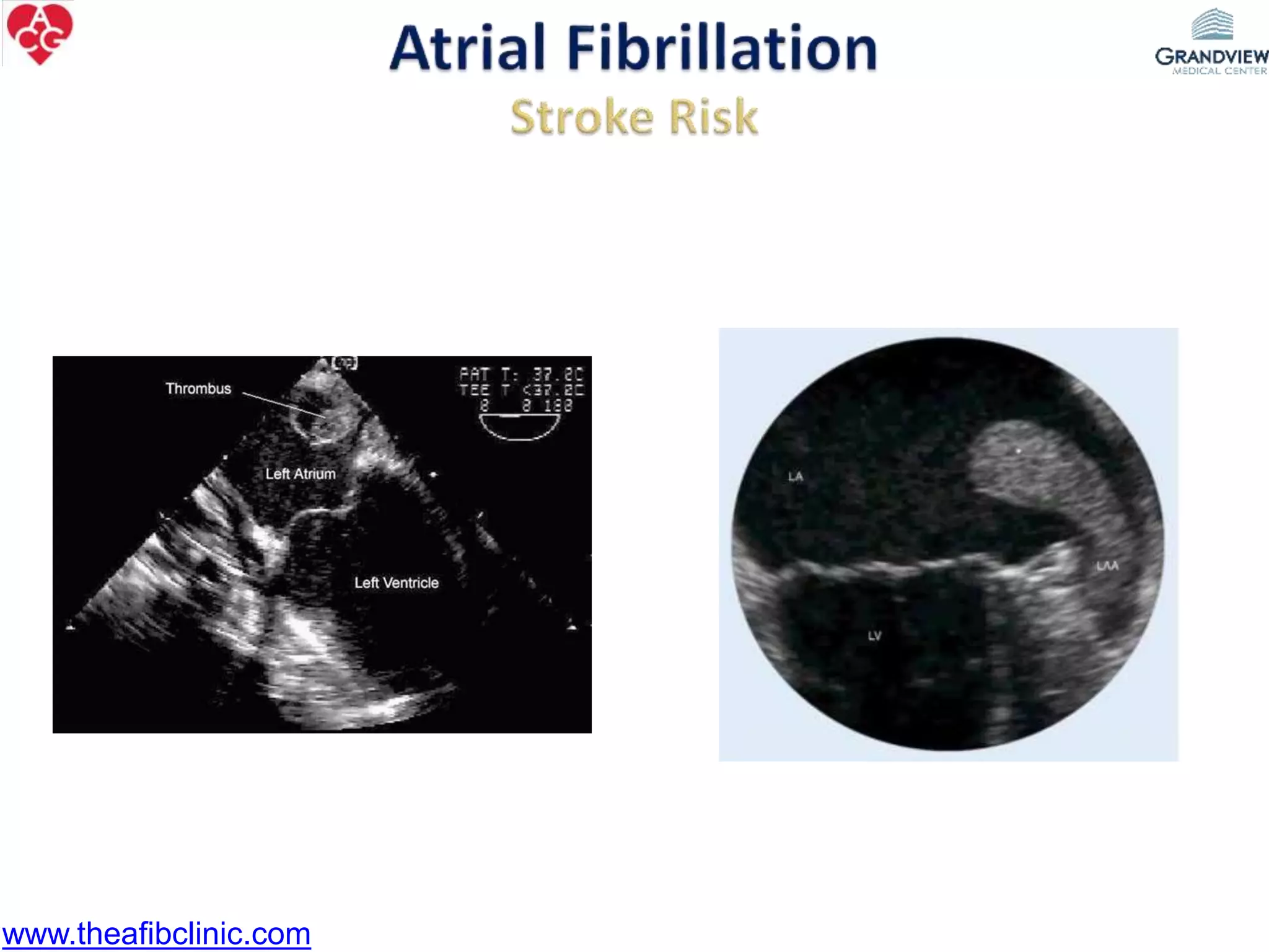 Afib and Stroke Prevention Update | PPTX