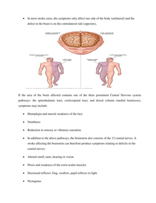 @ Stroke seminar | PDF
