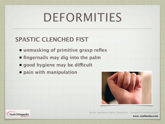 Spasticity in Stroke and Brain Injury Patients | PPT