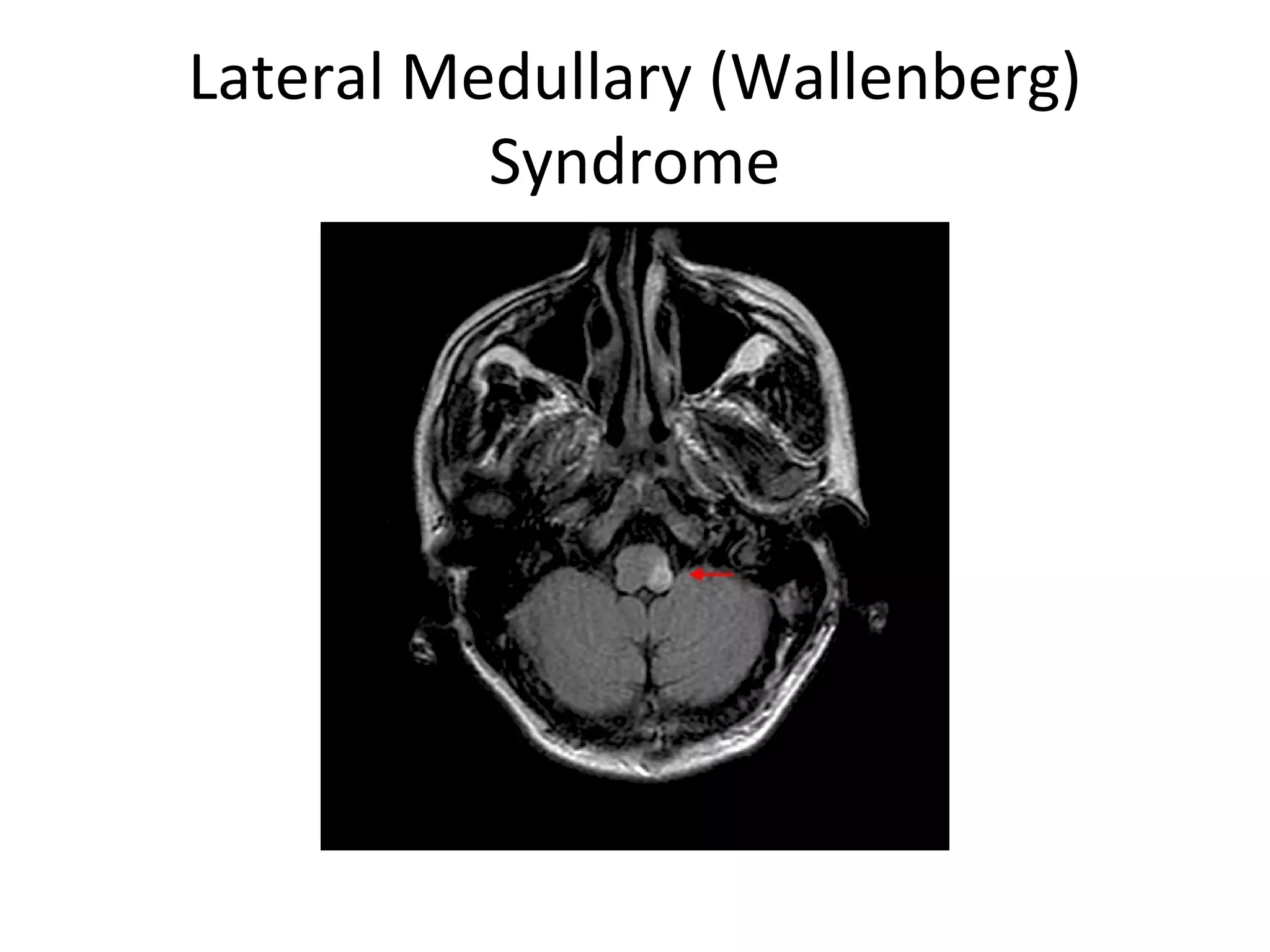 stroke syndrome 2.pdf