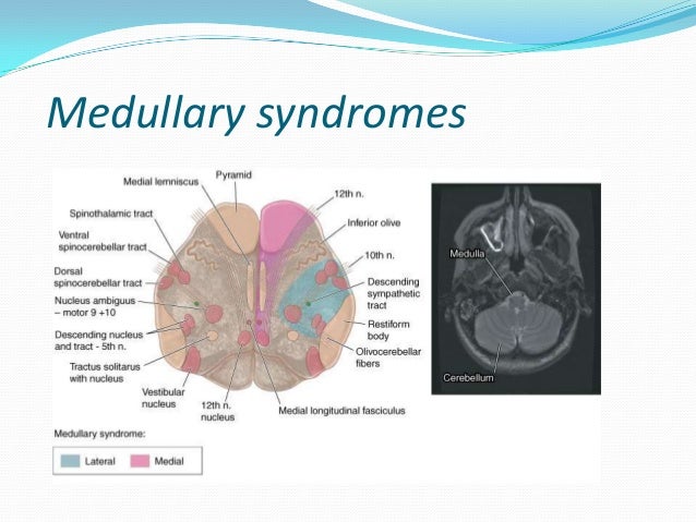 Wallenberg syndrome powerpoint pica syndrome powerpoint - szlery