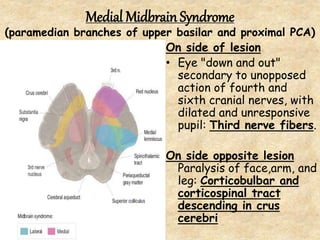 Paramedian Midbrain Syndrome