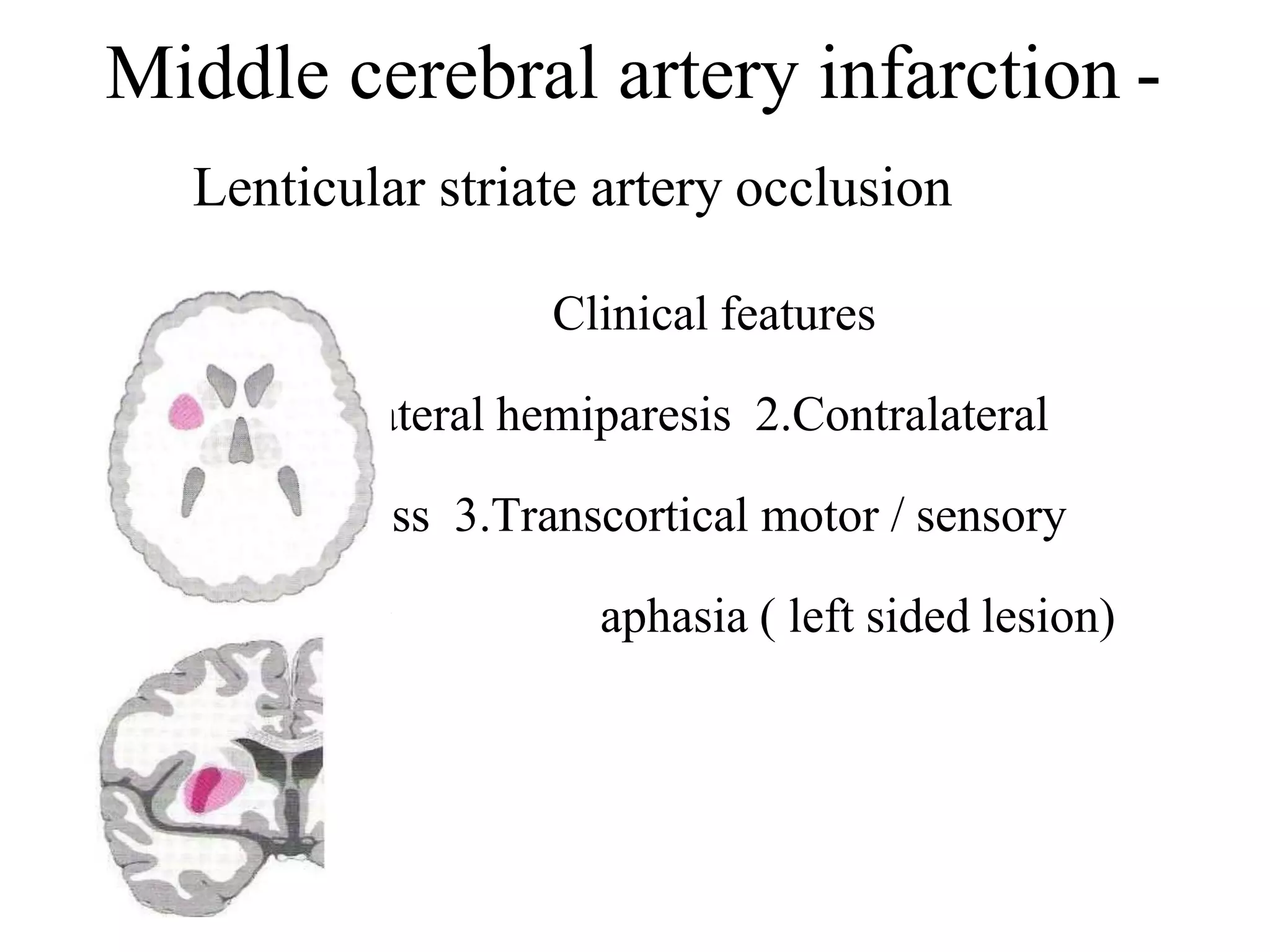 Stroke Syndromes - By Prof. Dr.Dhanarj.M (Sr.Consultant Neurologist) | PPTX
