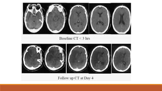 Stroke Treatment Protocol.pptx