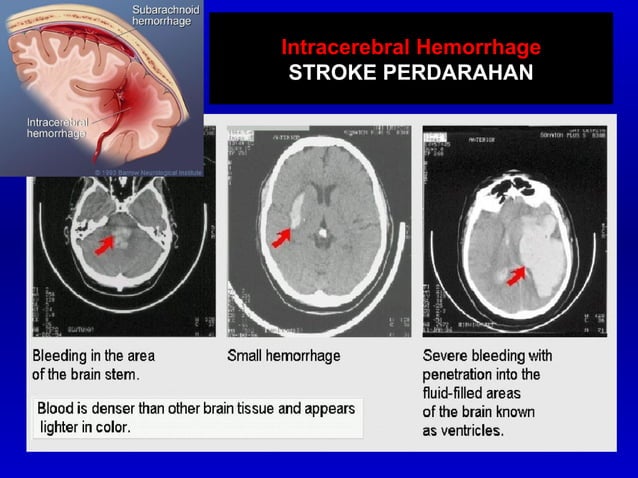 Stroke Basic Knowledge Bhs Indonesia | PPT
