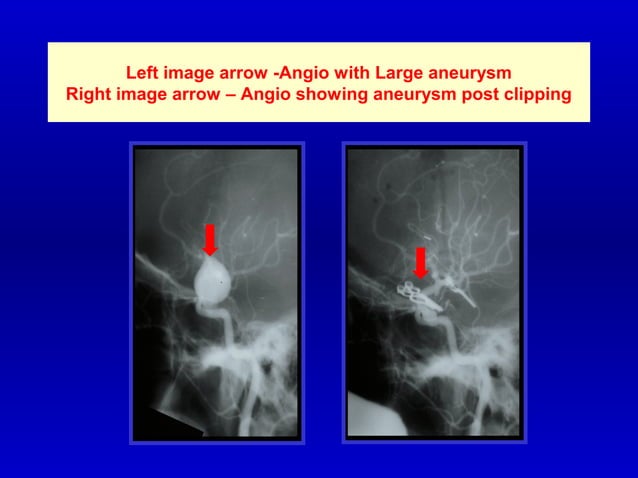 Stroke Basic Knowledge Bhs Indonesia | PPT