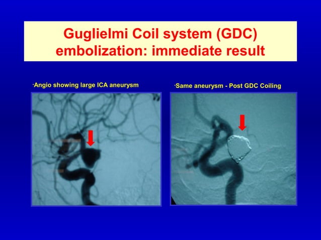 Stroke Basic Knowledge Bhs Indonesia | PPT
