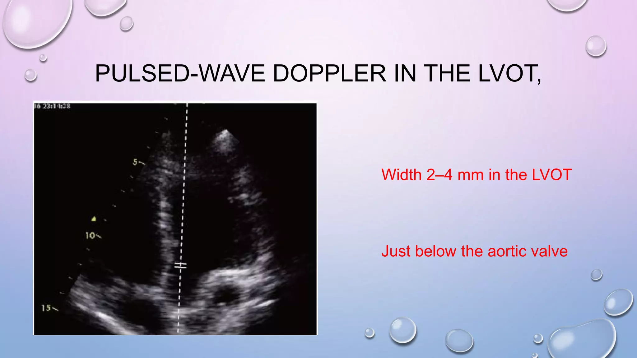 Stroke Volume And Cardiac Output Pptx Heart And Cardiovascular Diseases Diseases And