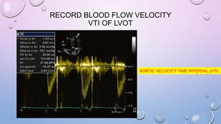 Stroke volume and cardiac output | PPTX