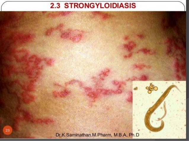 Strongyloides