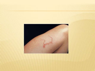 Powerpoint strongyloides stercoralis.ppt