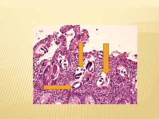 Powerpoint strongyloides stercoralis.ppt