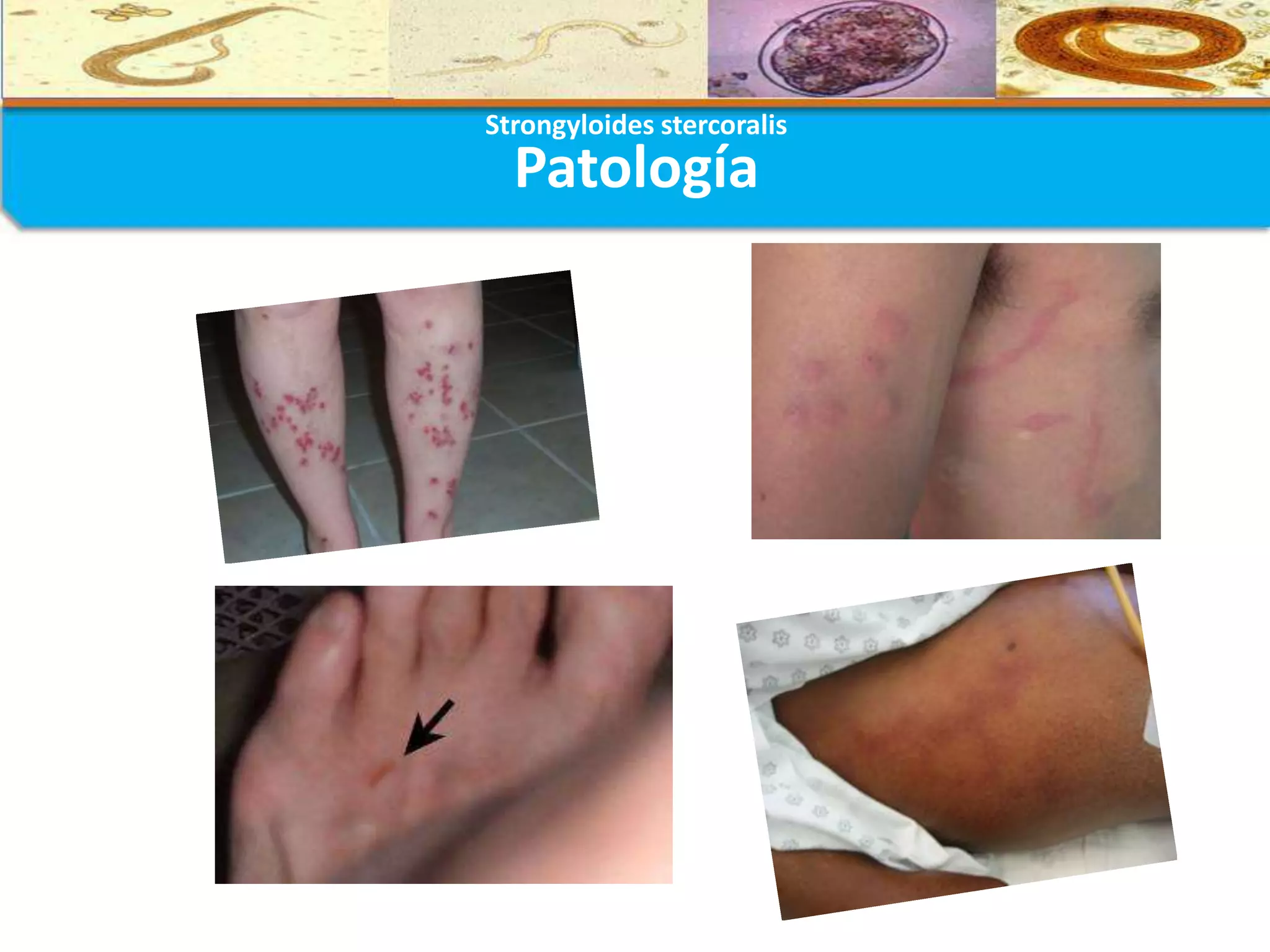 Strongyloides stercoralis
