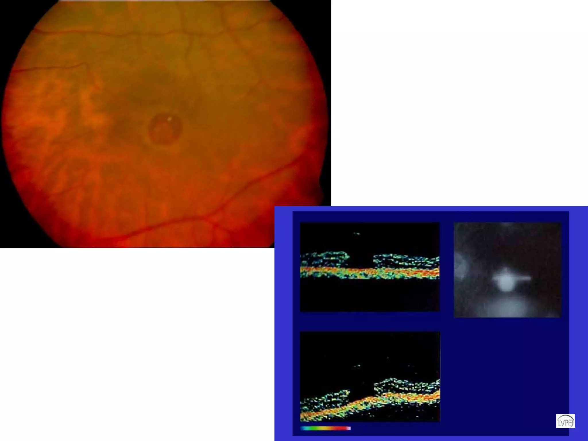 Structural and oct changes in diabetic retinopathy1 | PPTX