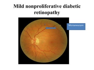 Structural and oct changes in diabetic retinopathy1 | PPTX