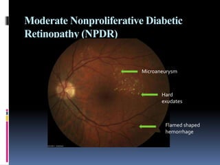 Structural and oct changes in diabetic retinopathy1 | PPTX