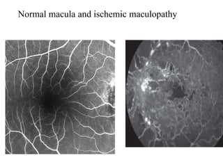 Structural and oct changes in diabetic retinopathy1 | PPTX