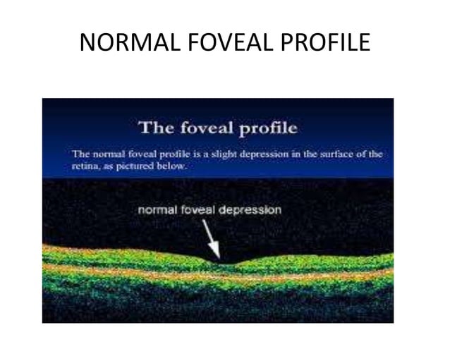 Structural and oct changes in diabetic retinopathy1 | PPTX | Eye and ...