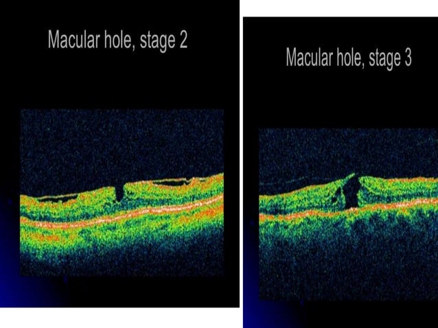 Structural and oct changes in diabetic retinopathy1 | PPTX | Eye and ...