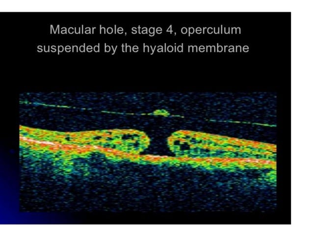 Structural and oct changes in diabetic retinopathy1 | PPTX | Eye and ...