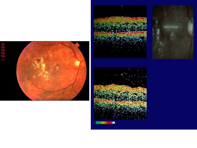 Structural and oct changes in diabetic retinopathy1 | PPTX | Eye and ...
