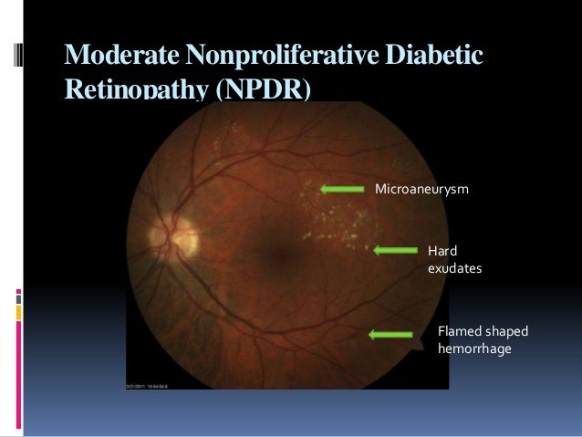 Structural and oct changes in diabetic retinopathy1