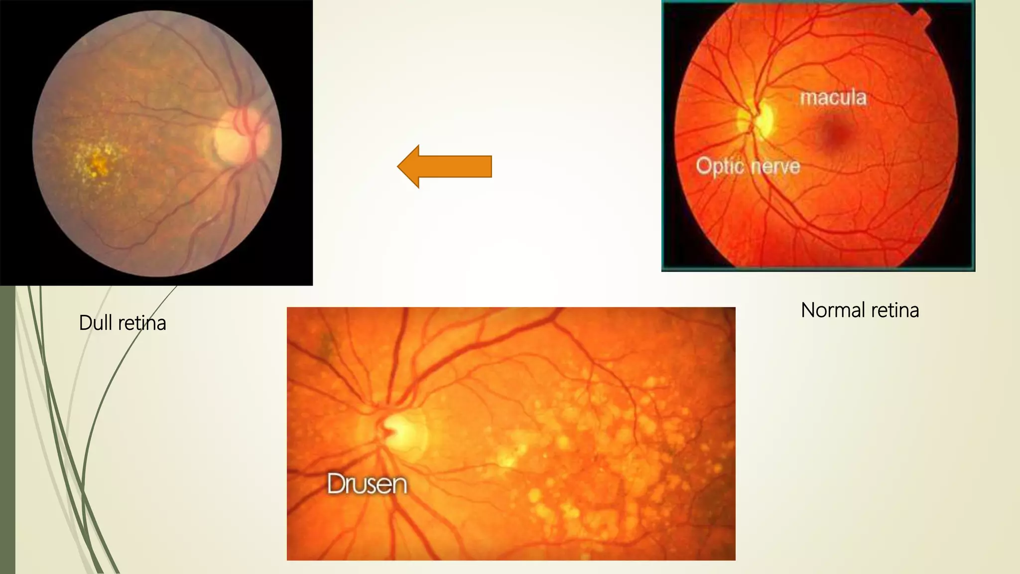 Structural cnanges in the eyes by rb | PPTX