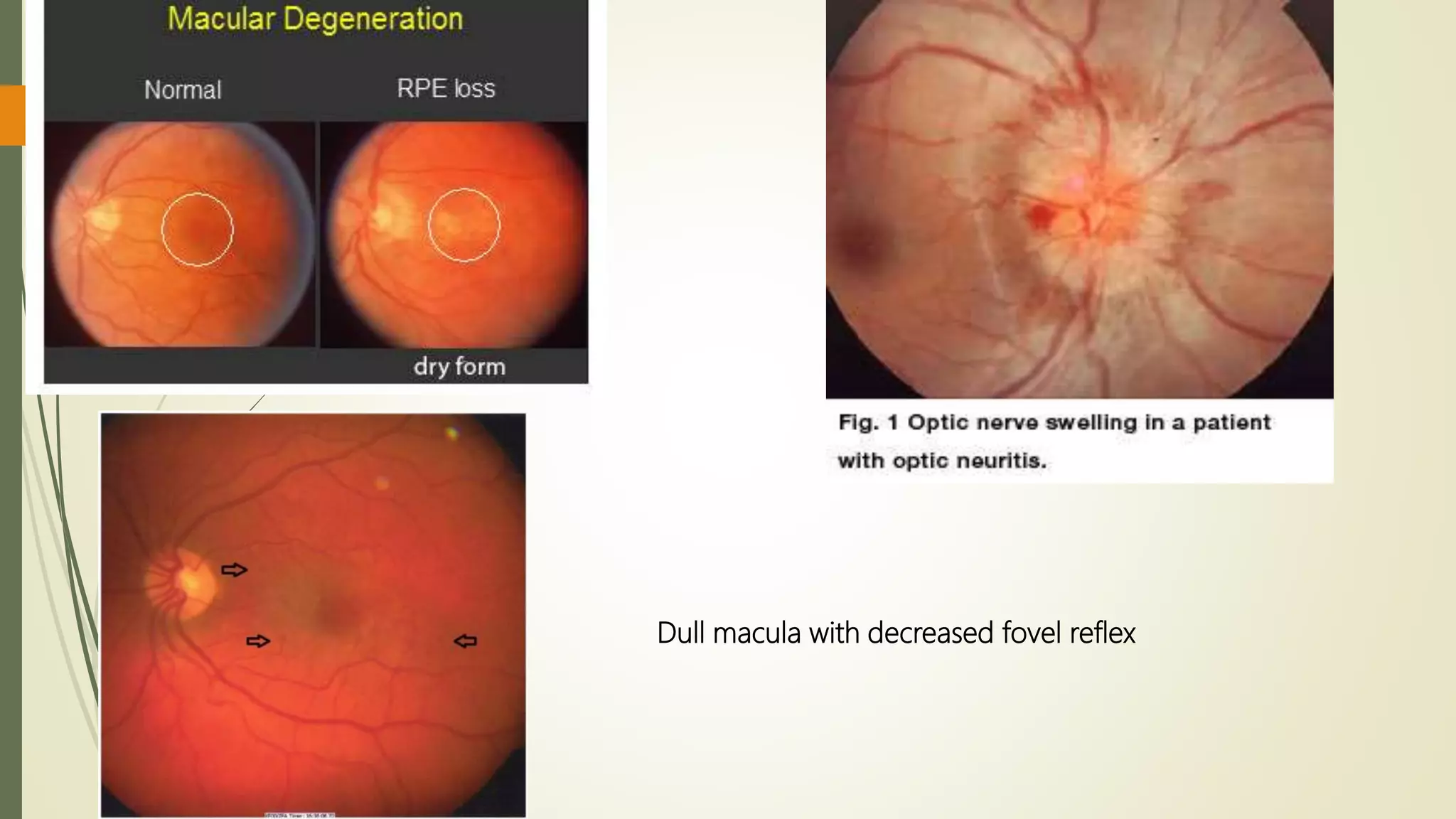 Structural cnanges in the eyes by rb | PPTX