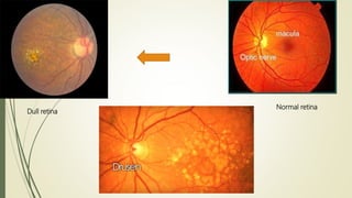 Structural cnanges in the eyes by rb | PPTX