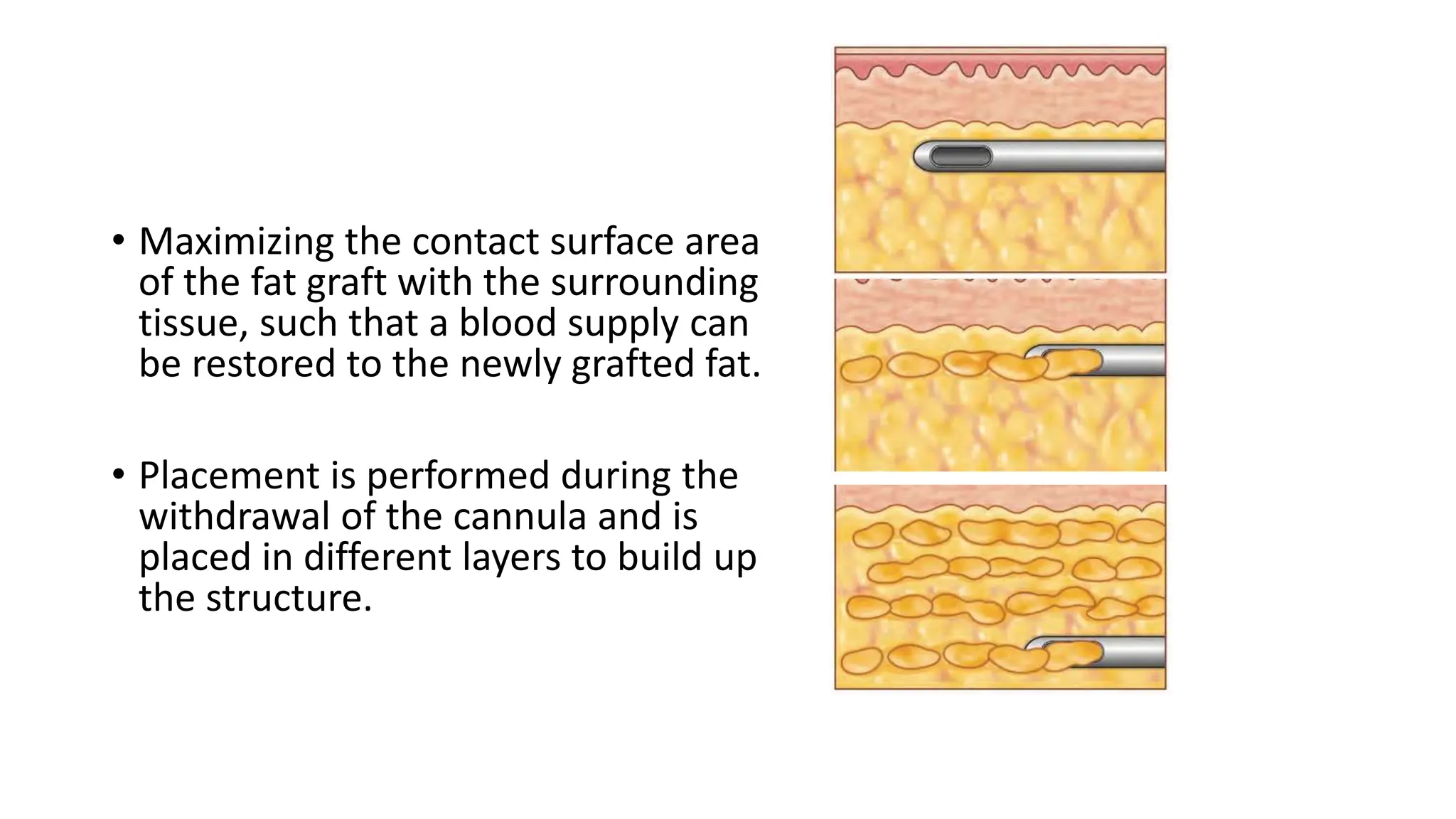 Structural fat grafting in plastic surgery. | PPTX