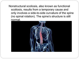 Structural vs. nonstructural scoliosis - cordus | PPT