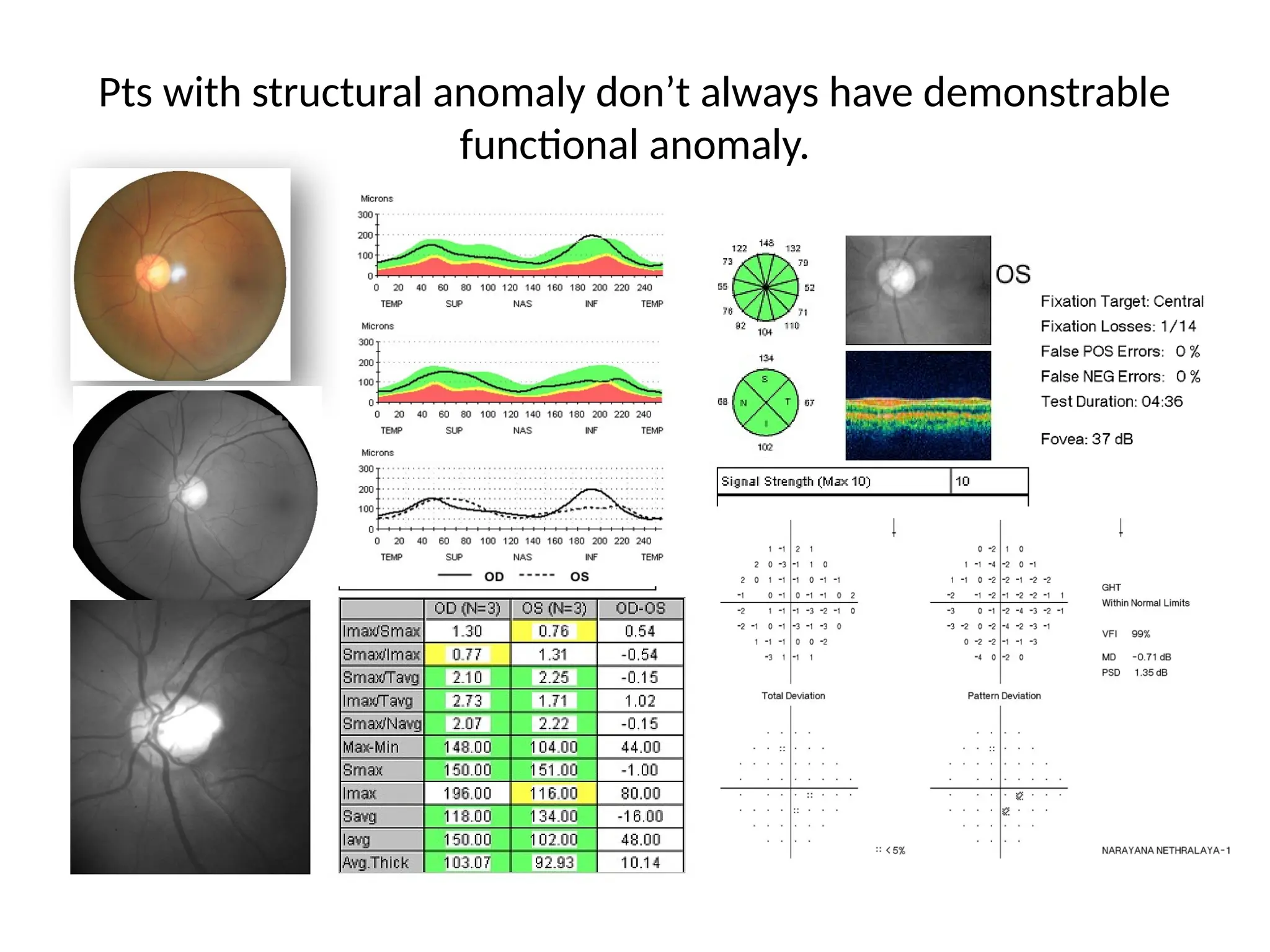 Structure and function relationship in glaucoma Vapi meet Dr Manan.pptx