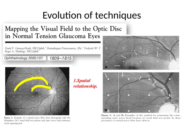 Structure and function relationship in glaucoma Vapi meet Dr Manan.pptx