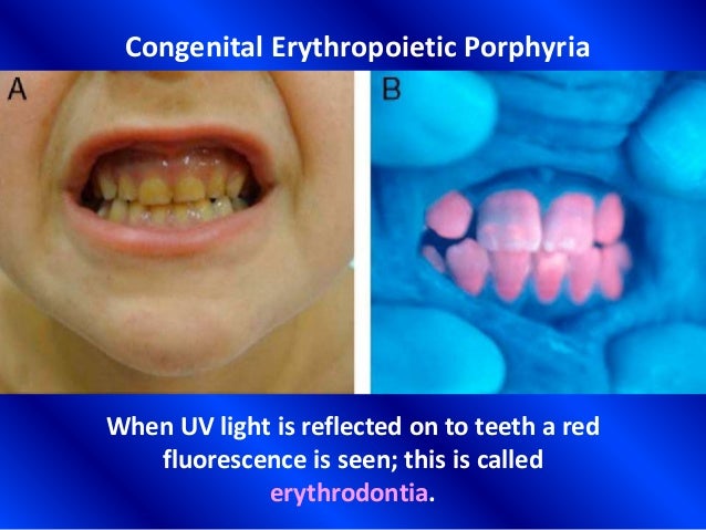 Heme Structure. synthesis and porphyrias