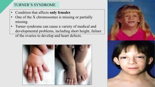 Structure of dna, types of dna forms, turners syndrome | PPTX