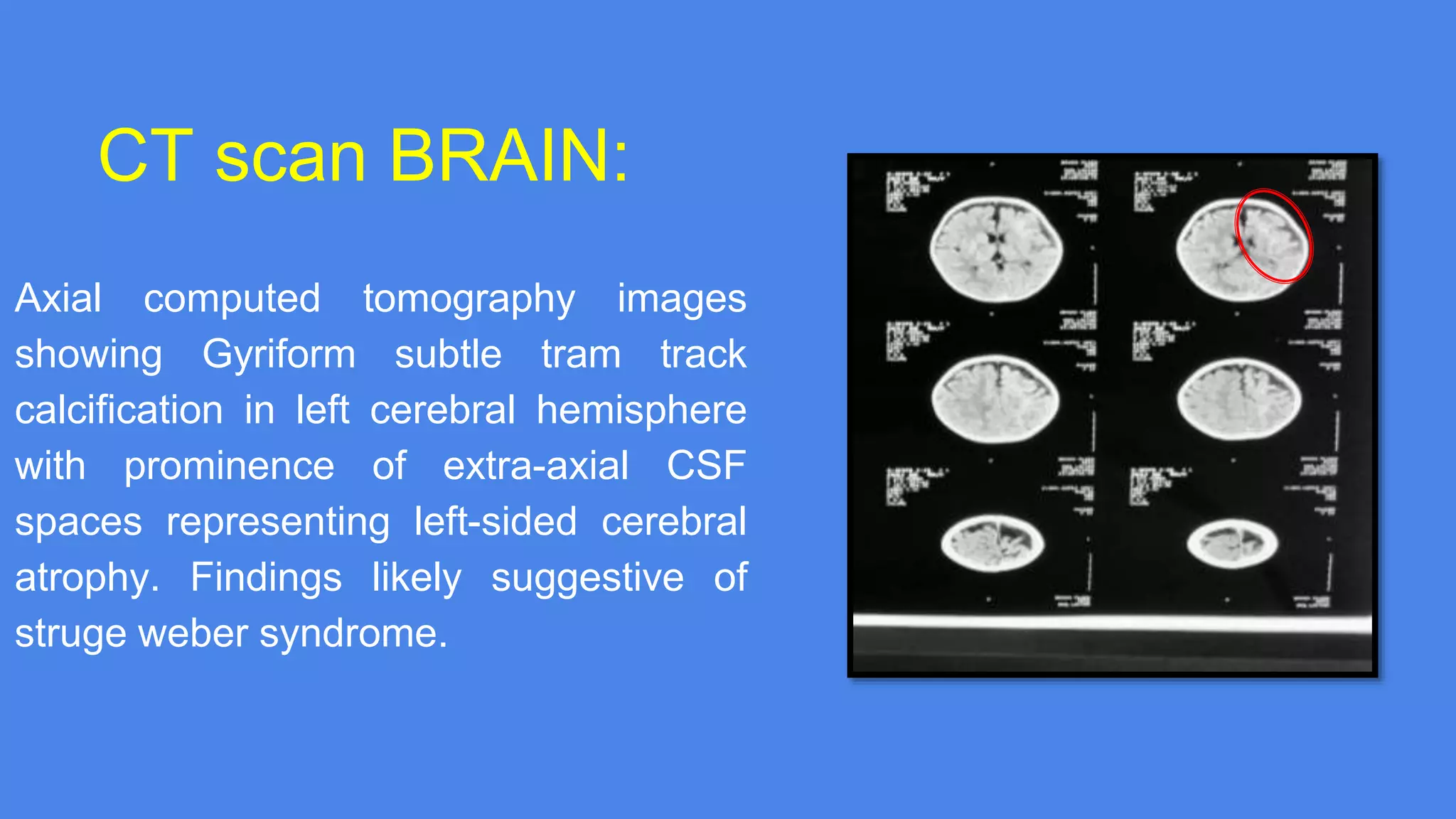 Struge weber syndrome case presentation | PPTX