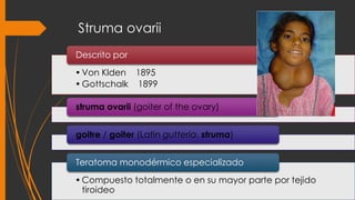 Struma ovarii | PPTX