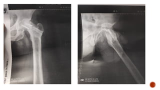 strut graft enhance neck femur union in.pptx